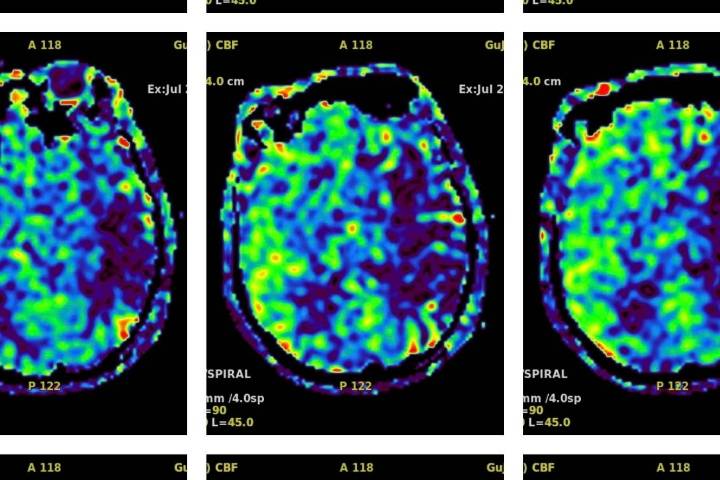 3D ASL在缺血性脑卒中中的应用_灌注_成像_患者