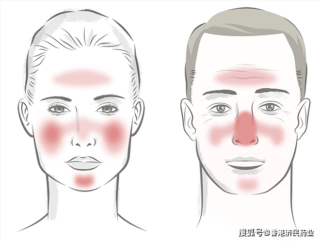 FDA批准emrosi（盐酸米诺环素缓释胶囊，40毫克）用于治疗酒渣鼻_病变_美国_试验