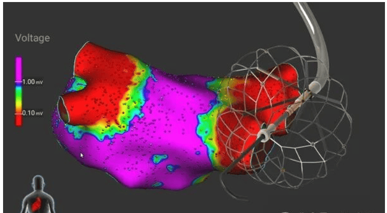 最新研究出炉！美敦力双能房颤消融导管_Sphere-_脉冲_的设计