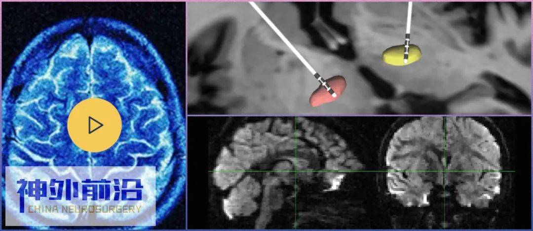 技术动态 | 生成精确脑图谱的Bullsai Incate平台获FDA批准 用于定位神经调控最佳靶点_先进的_方法