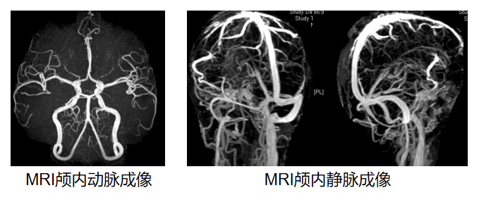揭秘血管成像黑科技——MRA、CTA、DSA的区别_技术_检查_疾病诊断