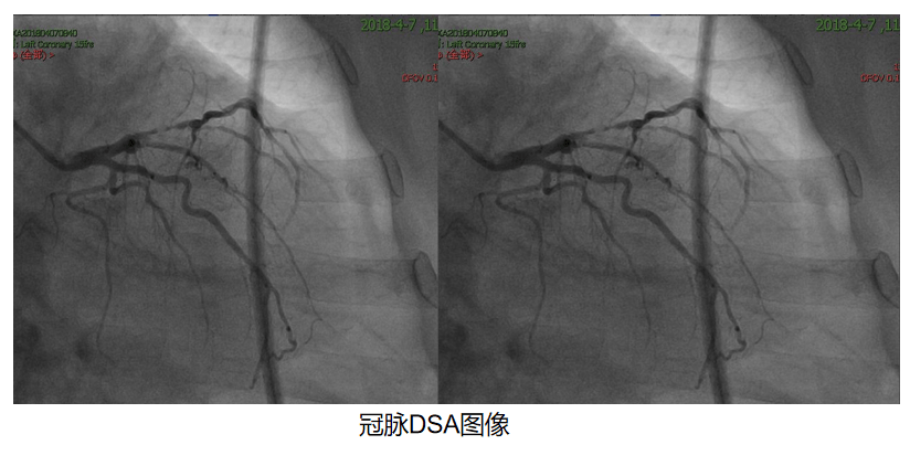 揭秘血管成像黑科技——MRA、CTA、DSA的区别_技术_检查_疾病诊断