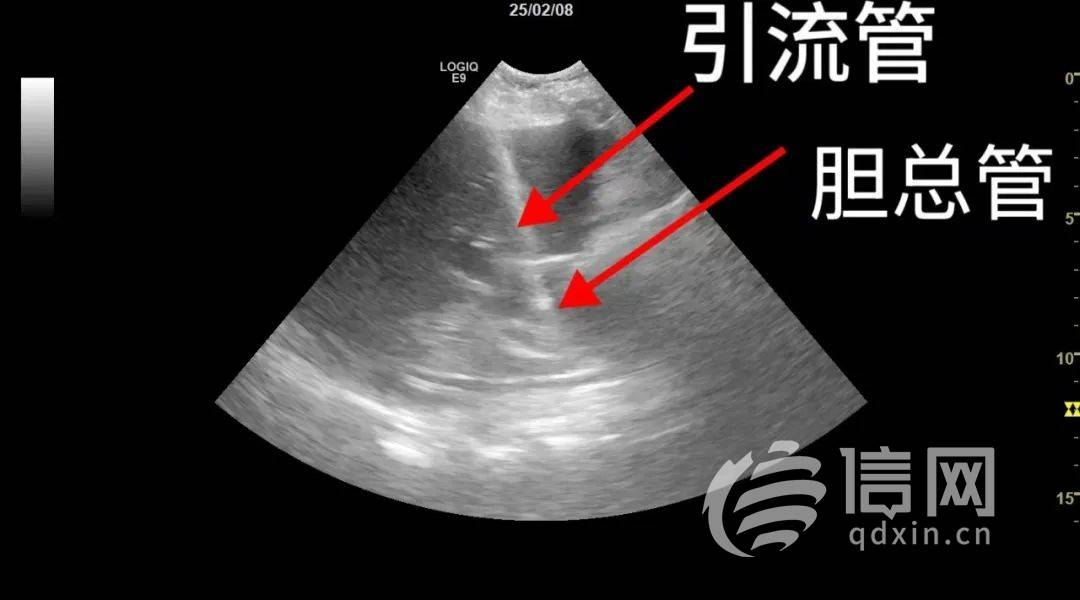 高难度！超声引导PTCD术成功救治94岁重症梗阻性黄疸患者_临床中心_手术