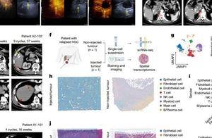 Nature | 浙江大学梁廷波团队利用溶瘤病毒VG161治疗难治性肝细胞癌！_免疫_患者_癌细胞