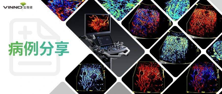 病例分享 | URM超分辨显微成像用于足踝部复发性淋巴瘤诊断_回声_微血管_皮下组织