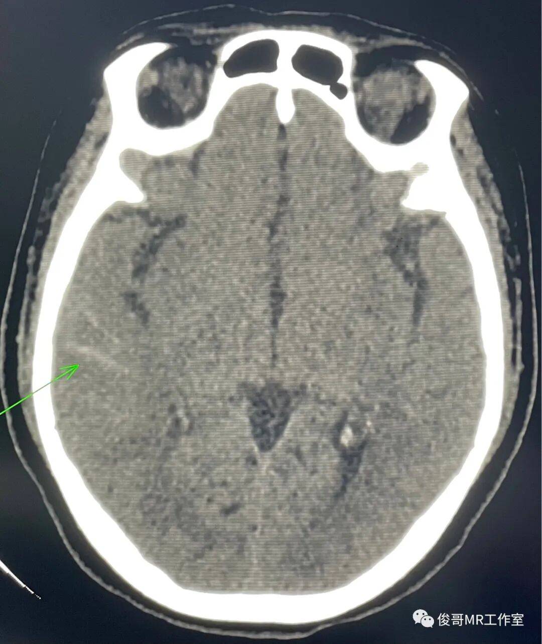 MRI如何诊断少量蛛网膜出血_脑沟_Minp_信号